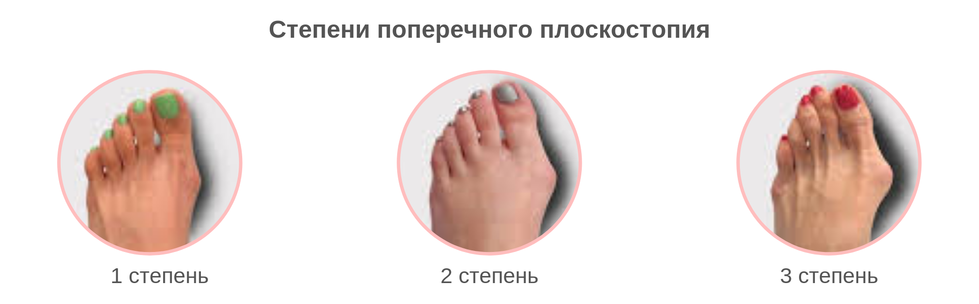 Ортопедическая обувь для дома при поперечном плоскостопии